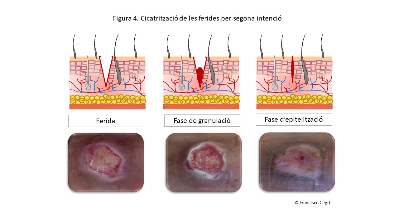 Infermeravirtual.com - Ferides i cremades, Problemes de salut